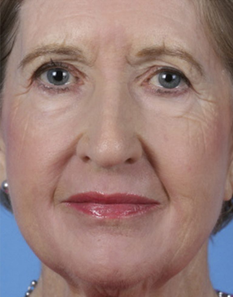 Contour TRL™ Laser Skin Resurfacing for Rochester, Brighton ...