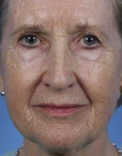 Contour TRL™ Laser Skin Resurfacing for Rochester, Brighton ...