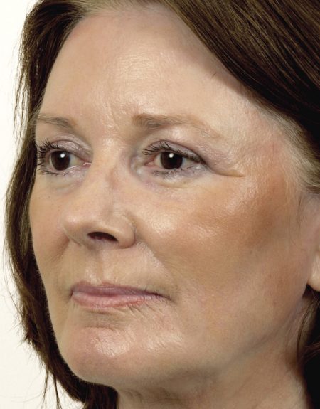 Contour TRL™ Laser Skin Resurfacing for Rochester, Brighton ...