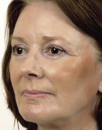 Contour TRL™ Laser Skin Resurfacing for Rochester, Brighton ...