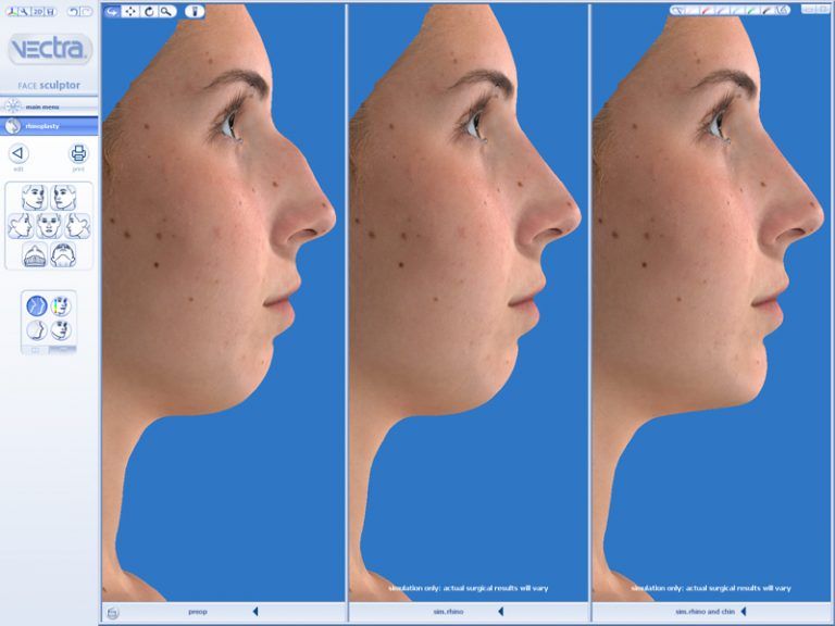 VECTRA® 3-D Imaging for Plastic Surgery in Rochester, NY | Dr. Calvin Young